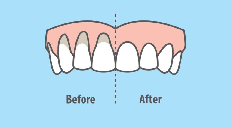 What Causes Gum Recession? - Spectrum Dental Group